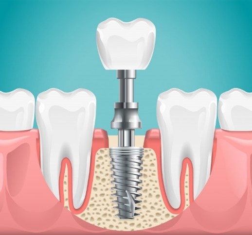 Dental Implant After Tooth Extraction | Dr. Philip A. Lisk